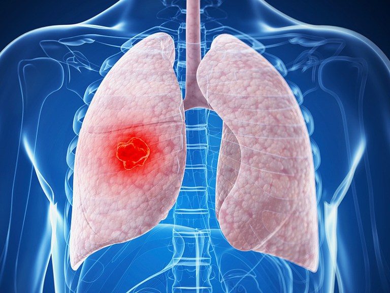 Metastazele pulmonare - Metastaze Pulmonare - Dan Nicolau